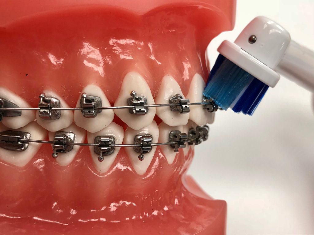 Tanden poetsen en een beugel - Orthodontiepraktijk Den Helder